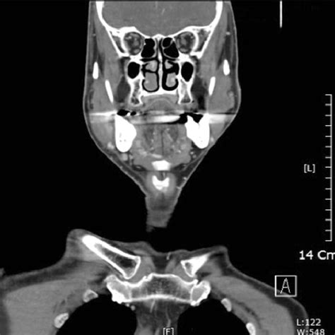 Cellulitis With Abscess Formation Within The Masseter Muscle Was Seen