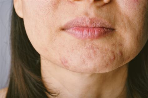 6 Ways To Manage Acne During Menopause Womens Health And Menopause