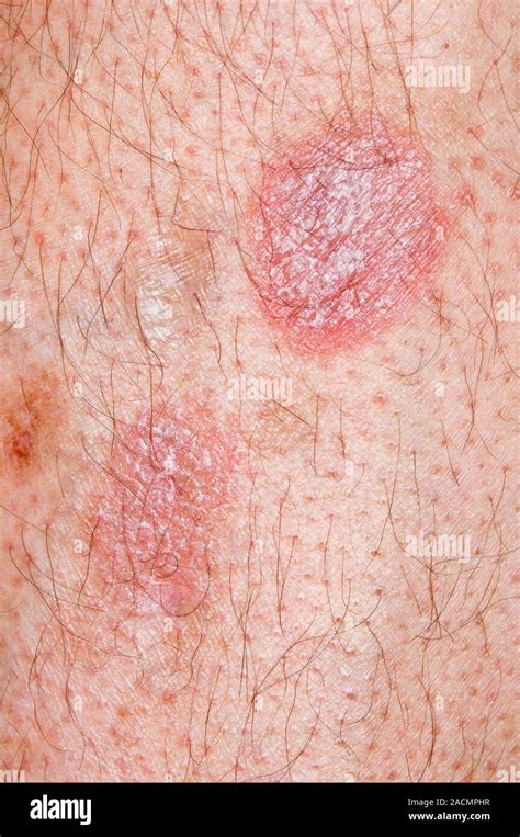 Treated Patches Of Scaling Skin On The Leg In A 32 Year Old South Asian Male Patient With