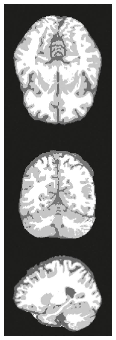 Intensity Inhomogeneity Correction Of Brain Mr Images A Original Mr Download Scientific