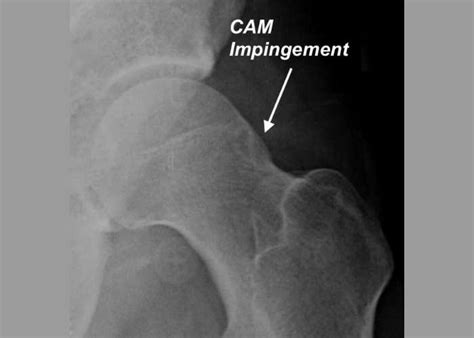 Cam Hip Impingement Cam Deformity In The Hip Ronak Mukesh Patel Md