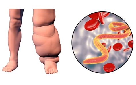 Nih Grant Supports Elephantiasis Vaccine Development