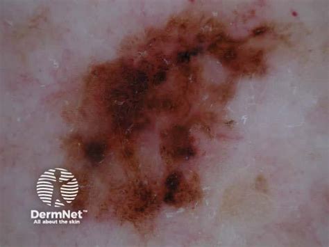 Dermoscopy First Step Algorithm