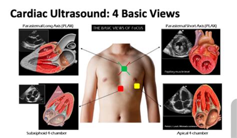 Ultrasound Echocardiogram Flashcards Quizlet