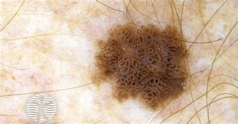 Dermoscopy Seborrhoeic Keratosis With Cerebriform Structures Image