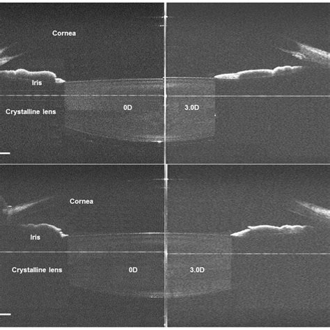 The Comparison Of OCT Images Obtained Before Left And After Right Download Scientific