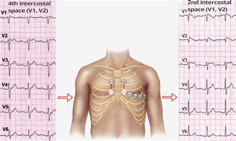 Brugada Syndrome Ecg Book