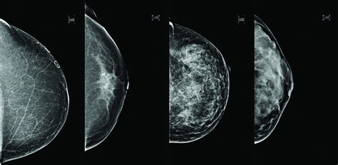 3d Automated Breast Ultrasound