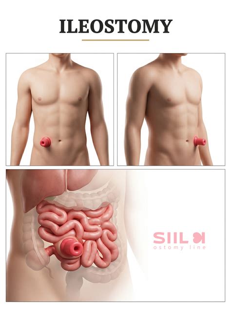 Ileostomy Vs Colostomy Vs Urostomy The Complete Medical Guide