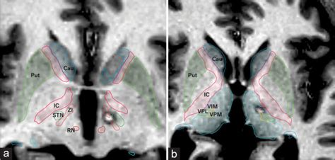 Radiofrequency Ablation Of The Pallidothalamic Tract And Ventral