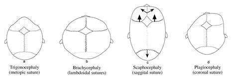 Craniosynostosis Definition Types Causes Symptoms Diagnosis And