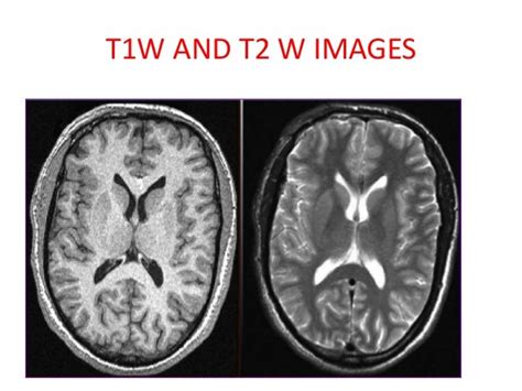 Normal Mri Brain