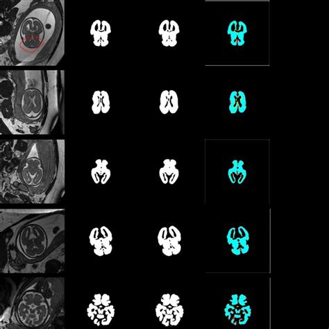 Examples Of Segmentation Results For Bottom Slices Note That Each Download Scientific Diagram