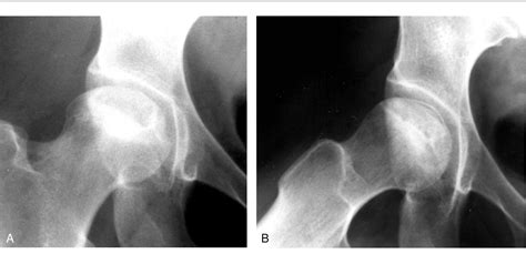 Figure 1 From Classification Classification Of Osteonecrosis Of The Femoral Head Reliability