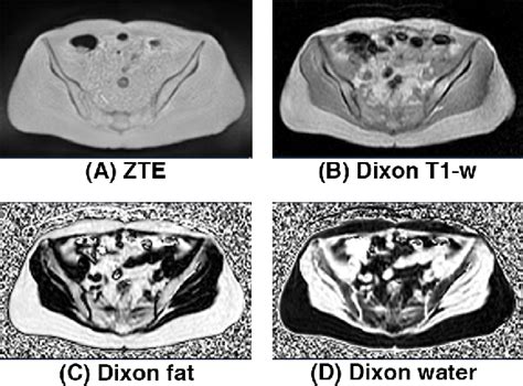 Figure 1 From Synthetic Ct Generation Using Mri With Deep Learning How Does The Selection Of