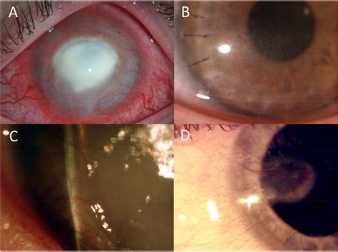Figure 1 From Current And Upcoming Therapies For Corneal Neovascularization Semantic Scholar