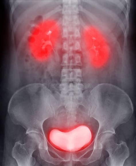 Intravenous Pyelogram Or Ivp Stock Image Image Of Nephrology