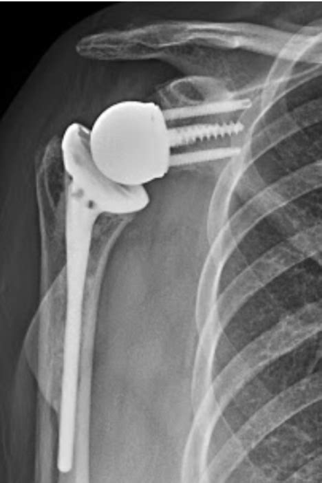 Uw Shoulder And Elbow Academy Stemless Reverse Total Shoulder Does