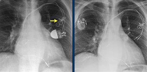 Ai Can Improve Xray Identification Of Pacemakers In