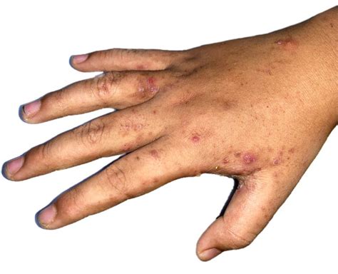 9 Common Causes Of A Rash On Palms With Treatments