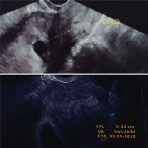 Pelvic Ultrasound Image Of Angular Pregnancy The Upper Panel The