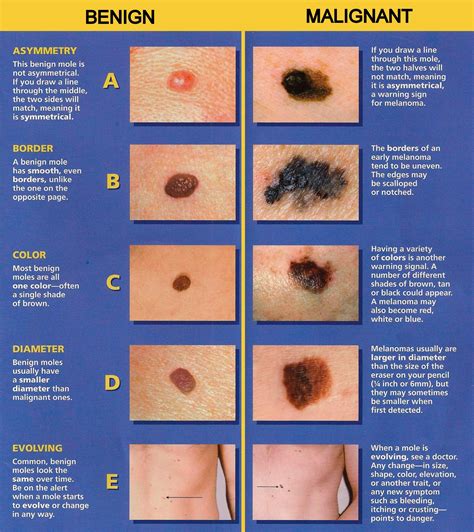 Understanding The Different Types Of Skin Moles