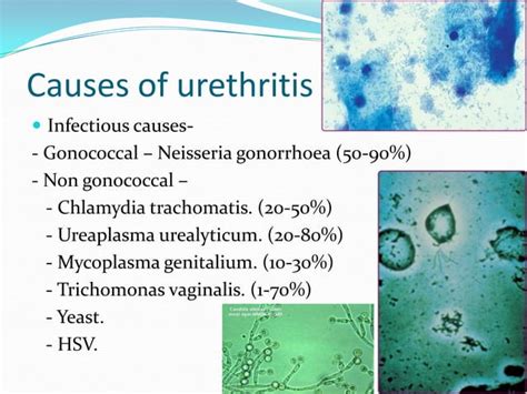 Urethritis