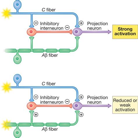 Spinal Cord Stimulation Implantation Techniques Anesthesia Key