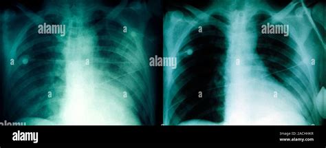 Pneumonic Plague Chest X Ray Of A Patient With A Progressive Plague