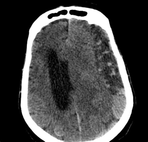 Non Enhanced Head Ct Scan Image Showing A Left Heterogenous Sdh With