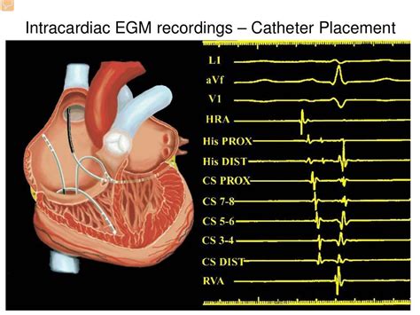 Intracardiac Electrograms