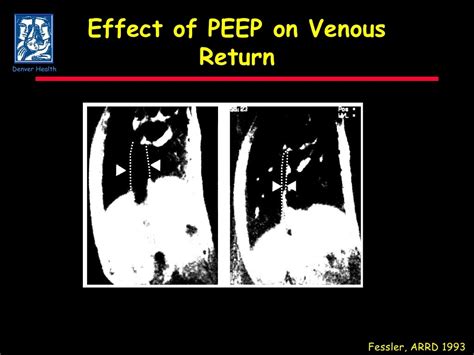 Physiology Of Peep In Ards