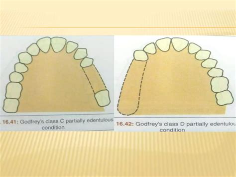 Introduction And Classification Of Removable Partial Denture Pptx