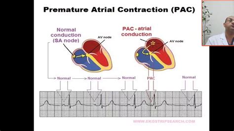 How To Differentiate Between Premature Atrial Pac And Ventricular Pvc My XXX Hot Girl