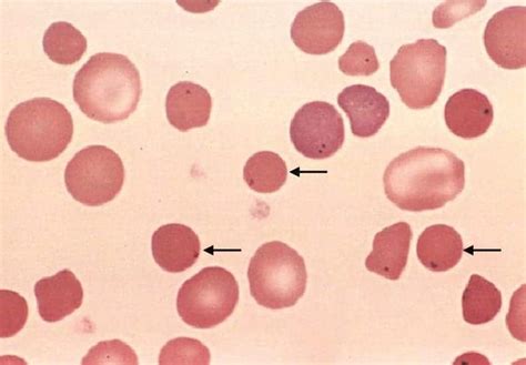 Hereditary Spherocytosis New