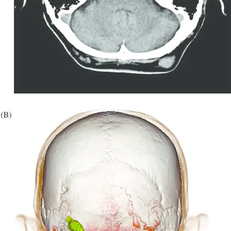 Plain Ct Revealed An Iso Density Area Lesion In The Subcutaneous Area Download Scientific