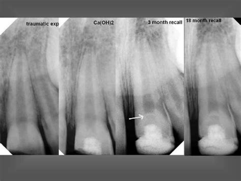 Apexogenesis And Apexification