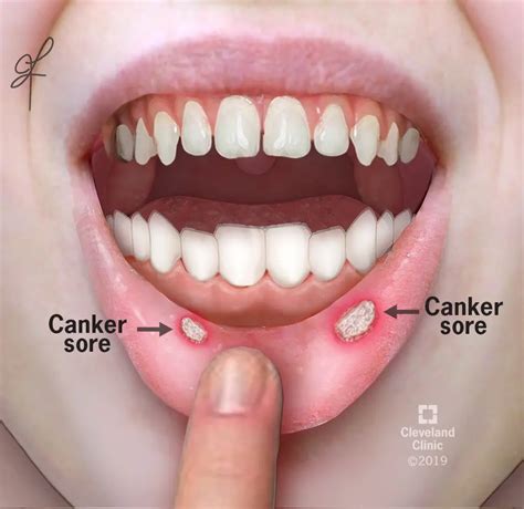 Gum Canker Sores Causes Treatment And Prevention Healthy Food Near Me