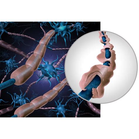 ¿qué Es La Esclerosis Múltiple Causas De La Esclerosis Múltiple