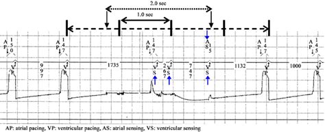 Ecg Of The Pacemaker Which Observed Oversensing In Ecg One Pacemaker