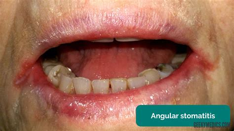 Paediatric Abdominal Examination Osce Guide Geeky Medics