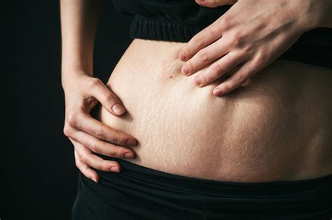 Stretch Marks How To Prevent And Treat Them
