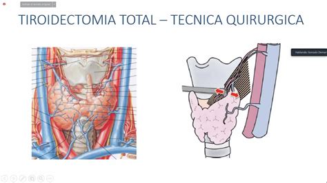 TiroidectomÍa Tiroides Cirugia Generalpdf TiroidectomÍa Tiroides Cirugia Generalpdf