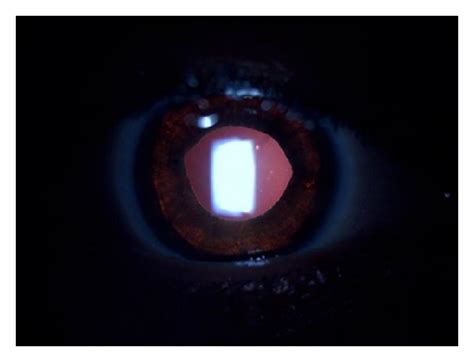 A Transillumination Defect Is Remarkable On The Biomicroscopic