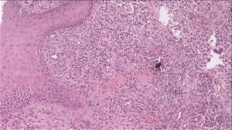 Unusual Presentation Of Multibacillary Nodular Leprosy Journal Of