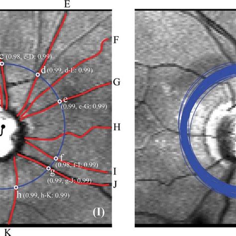 Retinal Fundus Image And Oct Circular Scan For The Same Eye The