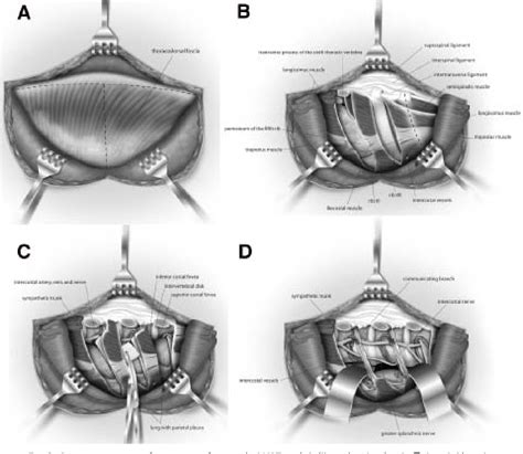 Paraspinal Muscle Hypertrophy Semantic Scholar