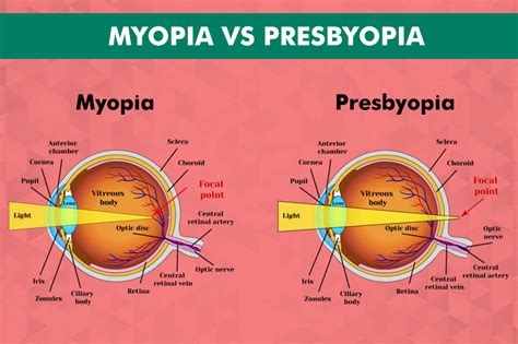Presbyopia Vs Myopia Whats The Difference Planet Lasik
