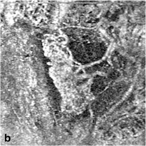 Different Patterns Of Myopic Choroidal Neovascularization Observed At Download Scientific