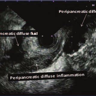 Diffuse Parenchymal Edema Diffuse Enlargement And Plastering Fluid Download Scientific